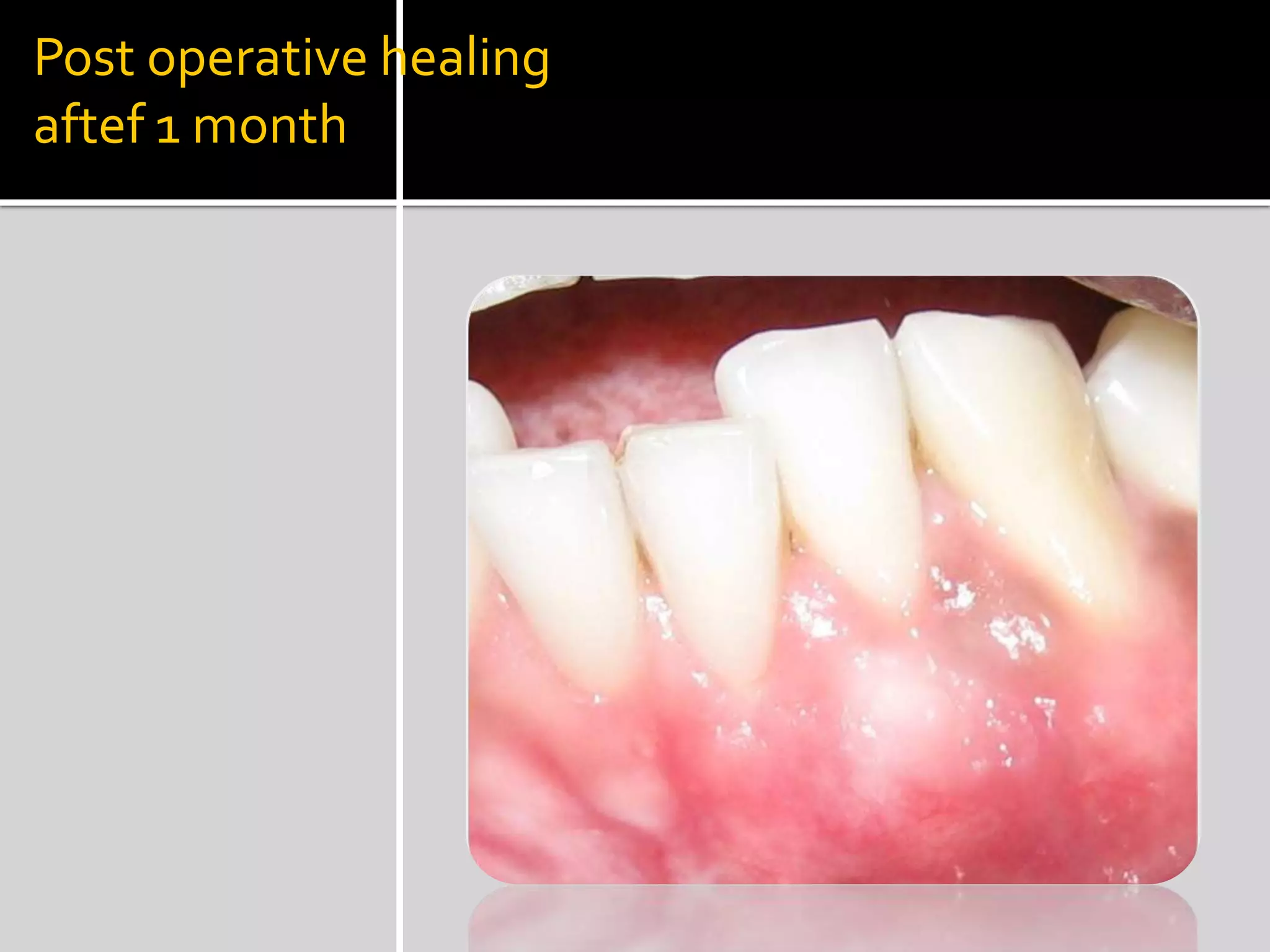 Coverage of Gingival Recession and Mucosal Fenestration copy.ppt