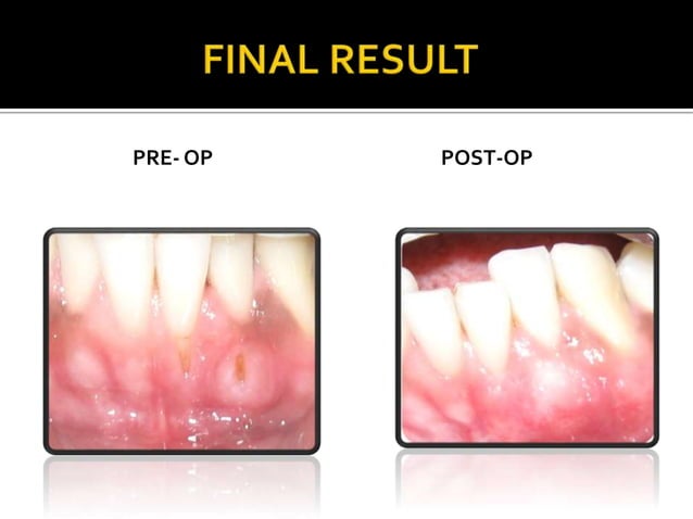 Coverage of Gingival Recession and Mucosal Fenestration copy.ppt ...