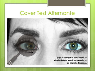 Examenes de estrabismo: Cover test | PPTX