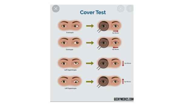 Cover test.pptx | Eye and Vision Conditions | Diseases and Conditions