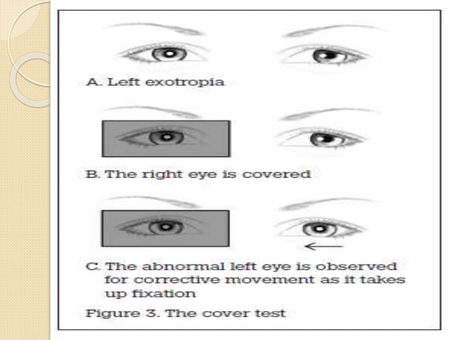 Cover tests | PPTX | Eye and Vision Conditions | Diseases and Conditions
