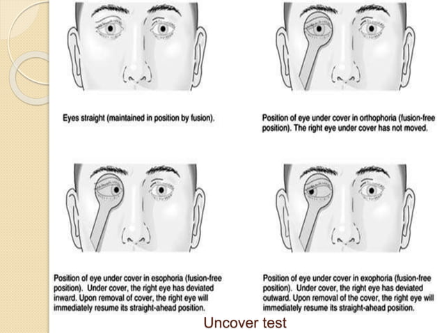 Cover tests | PPTX | Eye and Vision Conditions | Diseases and Conditions