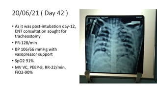 COVID -19 with Multiorgan dysfunction syndrome.pptx