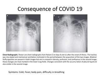 Covid 19 a short briefing | PPT