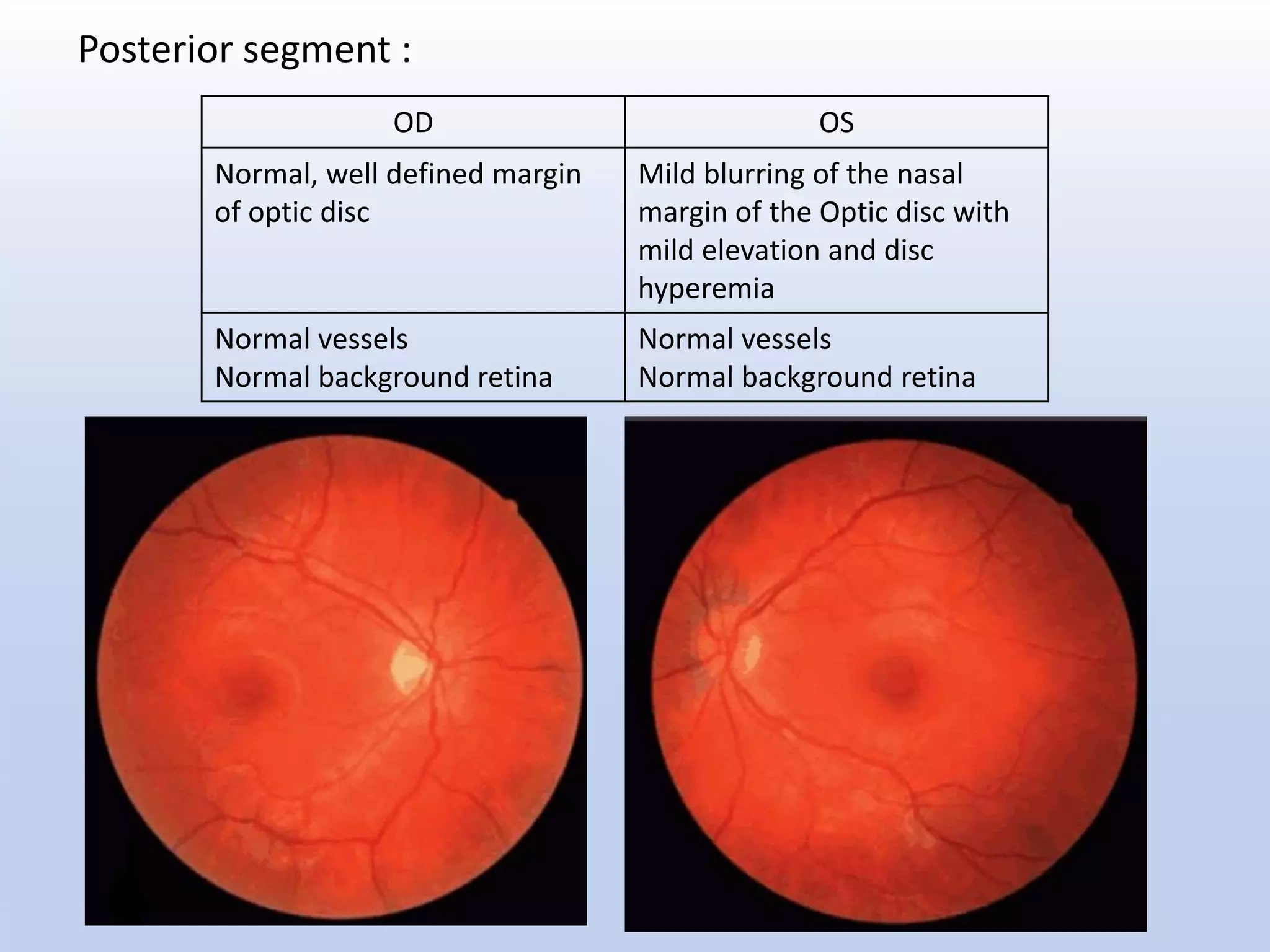 COVID 19 induced unilateral optic neuritis.pptx