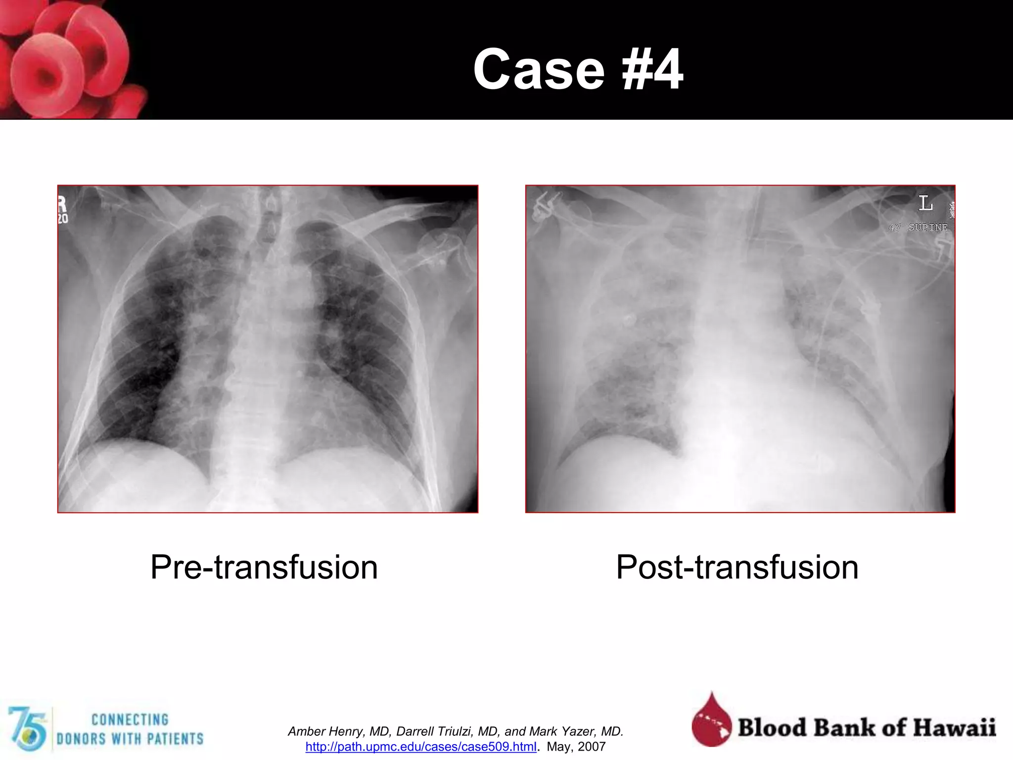 Common Transfusion Reactions by Randal Covin, MD, FCAP | PPT