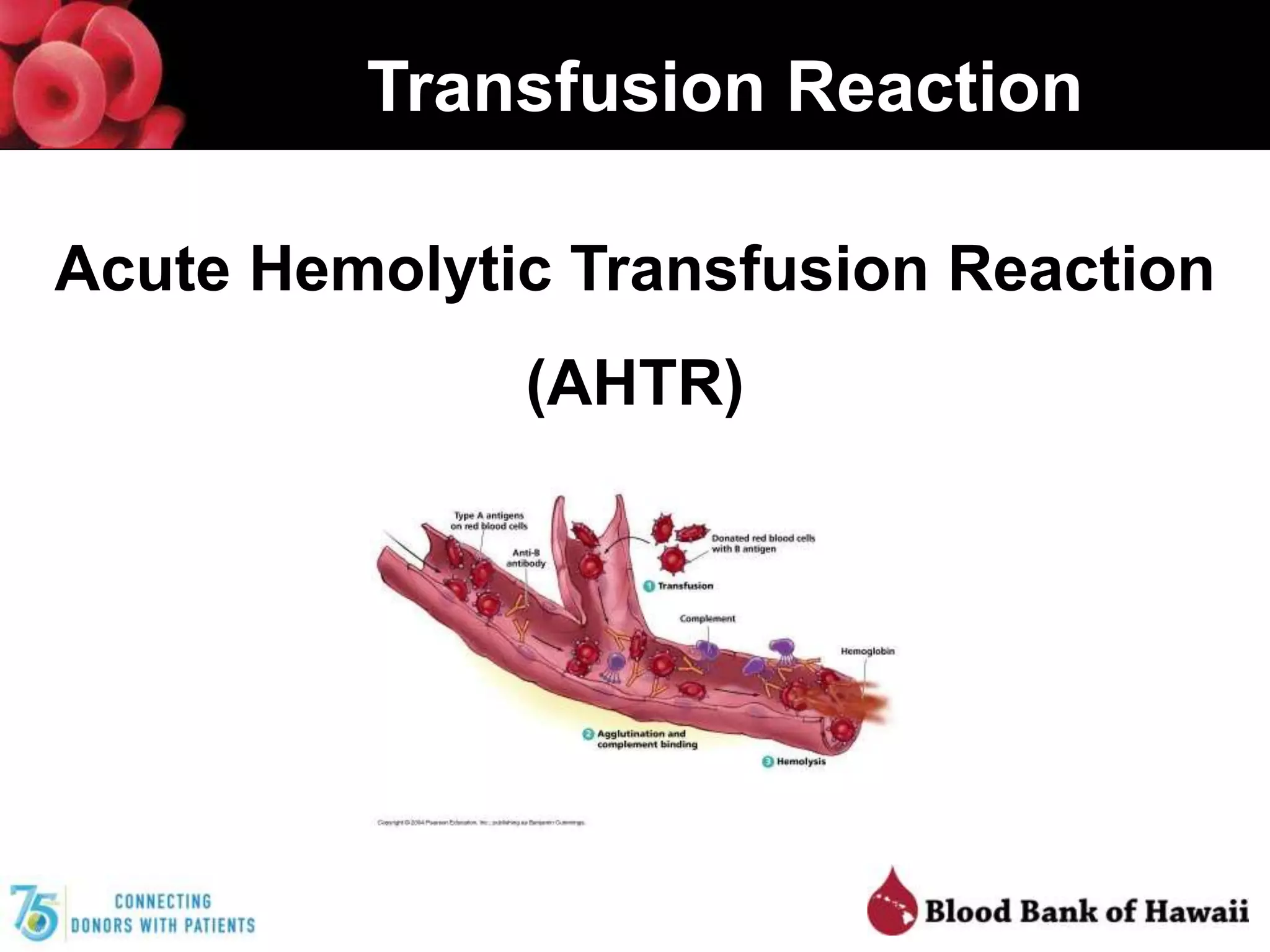 Common Transfusion Reactions by Randal Covin, MD, FCAP | PPT
