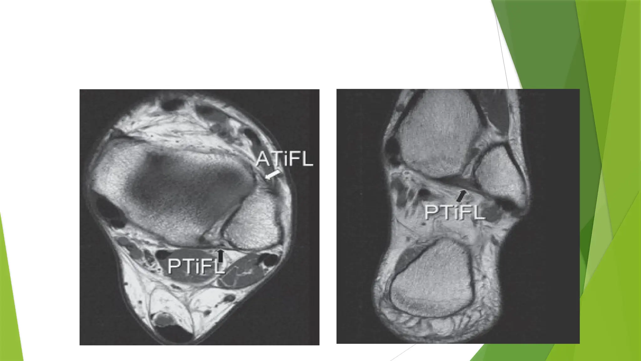 COW_ankle anatomy radiology with xrays and MRI | PPTX
