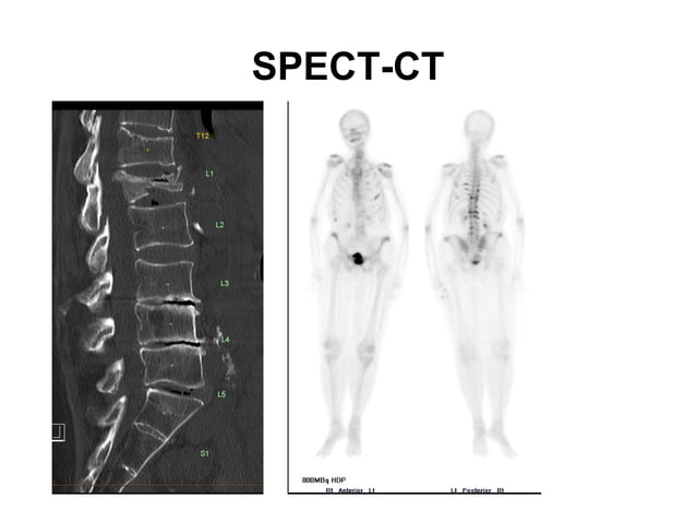 Imaging for back pain | PPT