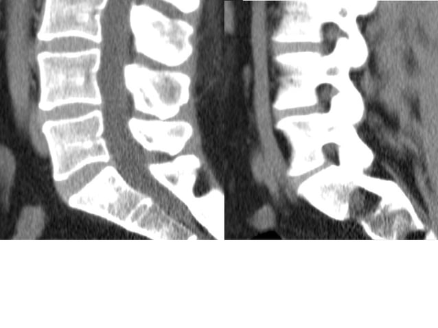 Imaging for back pain | PPT