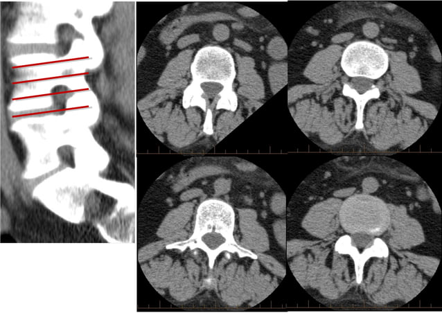 Imaging for back pain | PPT