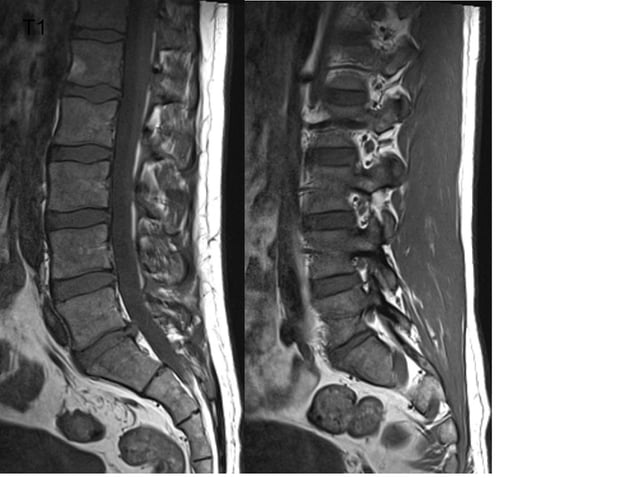 Imaging for back pain | PPT