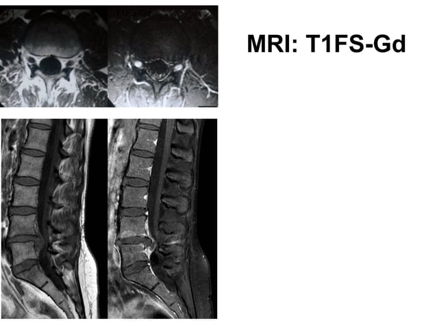Imaging for back pain | PPT