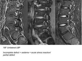 L5 Stress Reaction