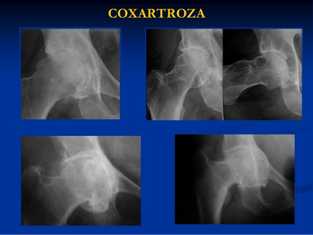 Coxartroza