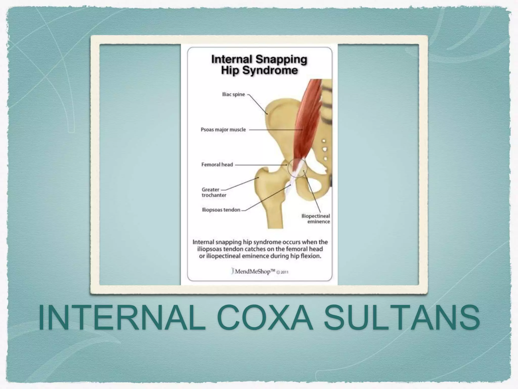 Coxa sultans - External Snapping Hip | PPTX