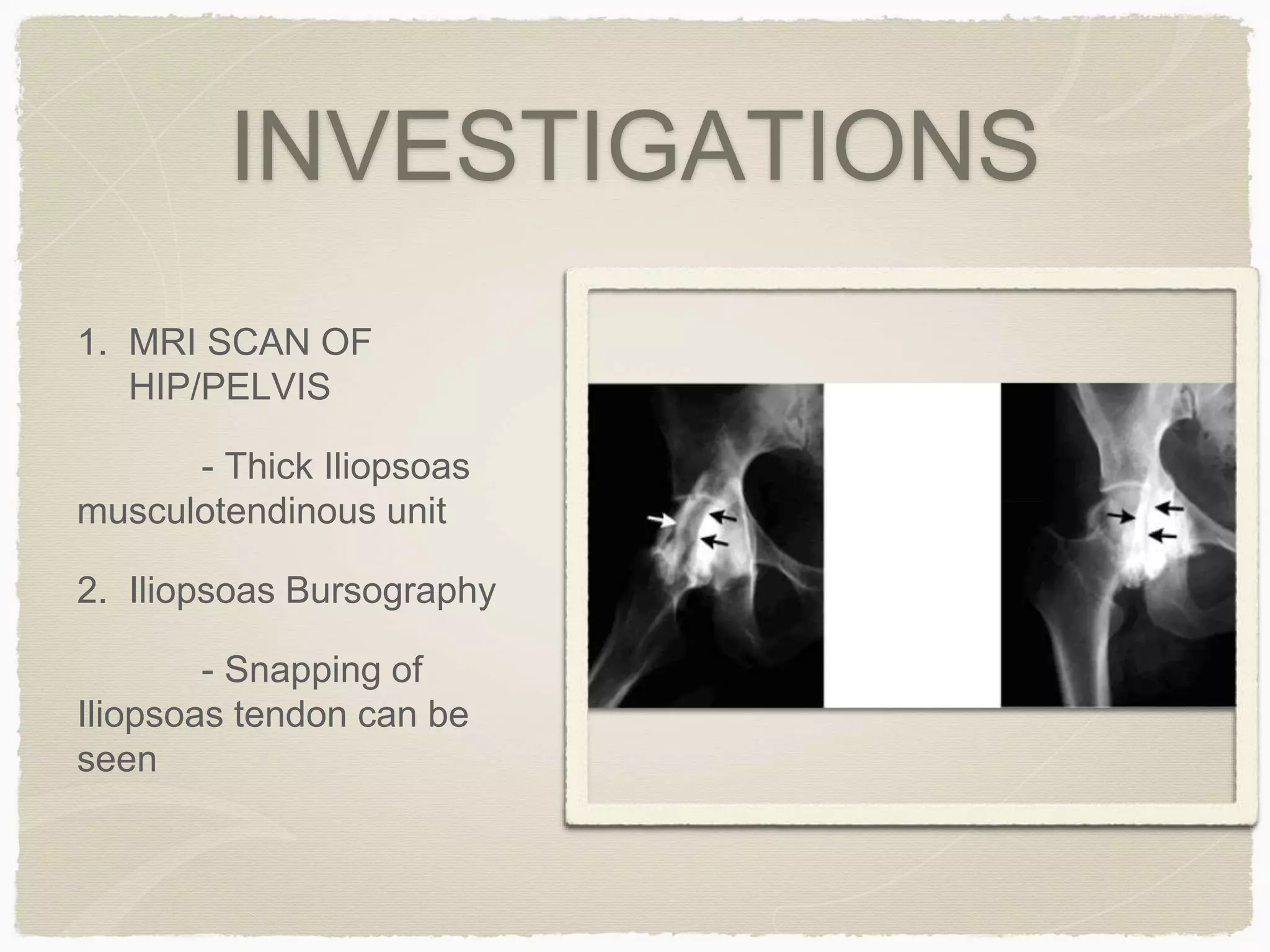 Coxa sultans - External Snapping Hip | PPTX
