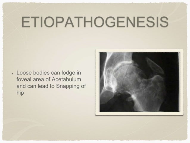 Coxa sultans - External Snapping Hip | PPTX