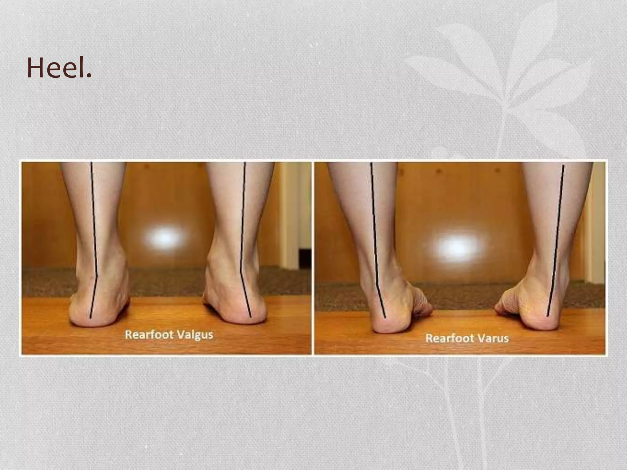 Coxa Vara, Genu VArum & Valgum. Under Gradts. | PPTX