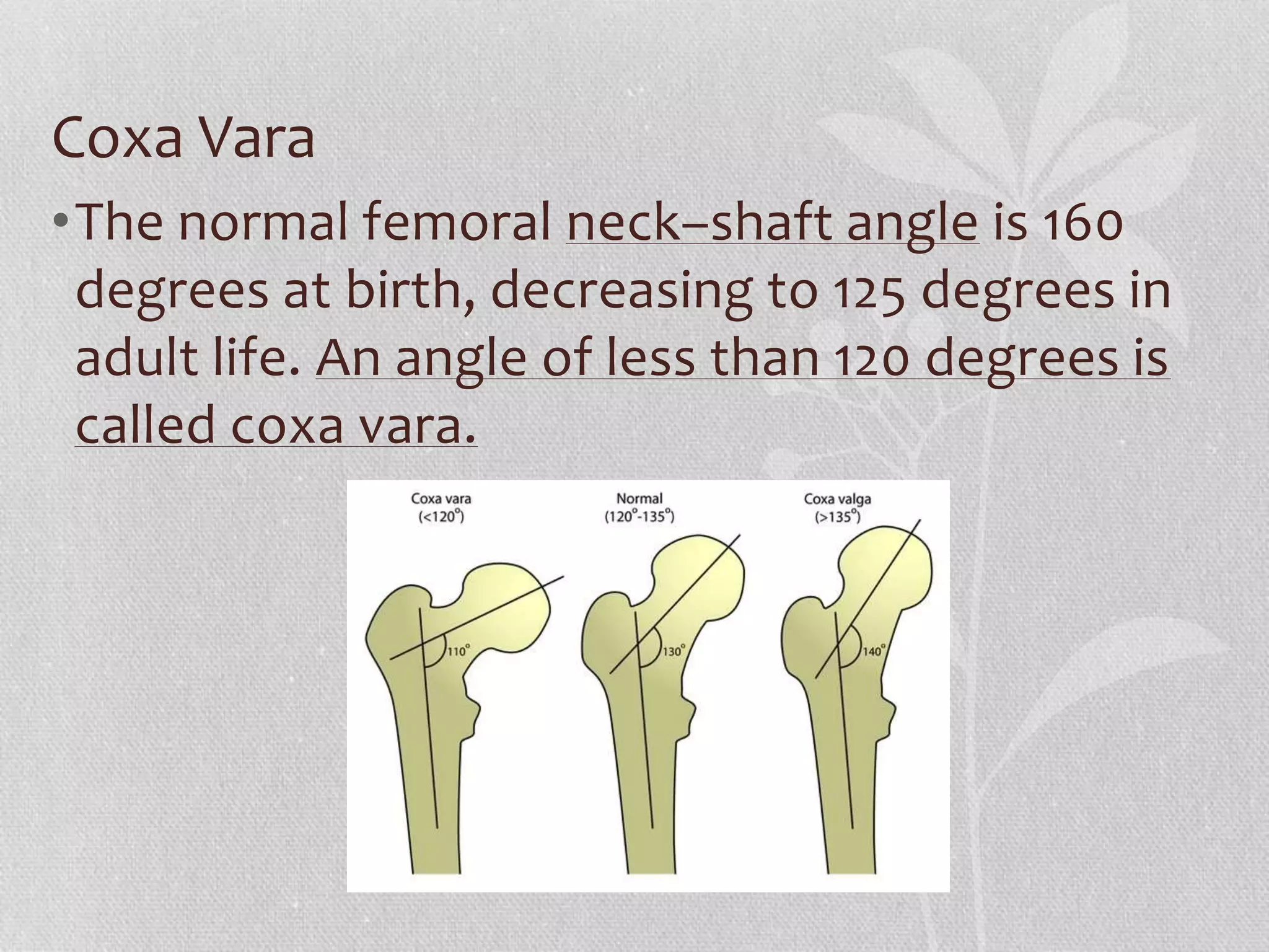 Coxa Vara, Genu VArum & Valgum. Under Gradts. | PPTX