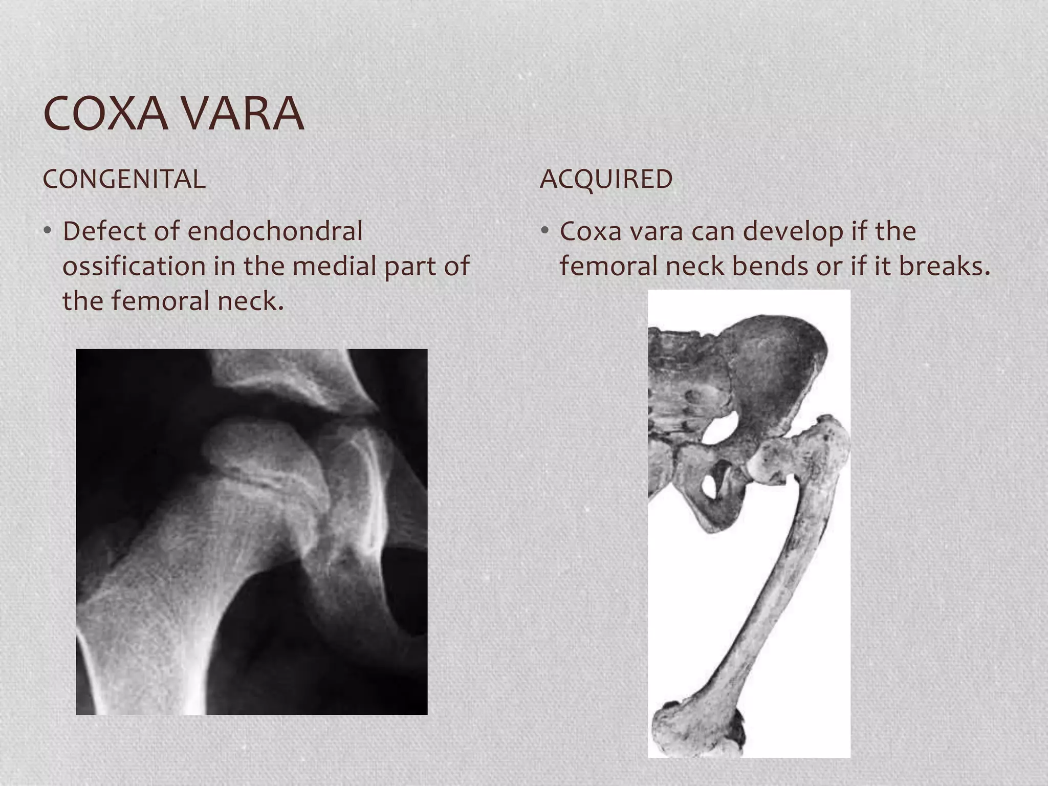 Coxa Vara, Genu VArum & Valgum. Under Gradts. | PPTX