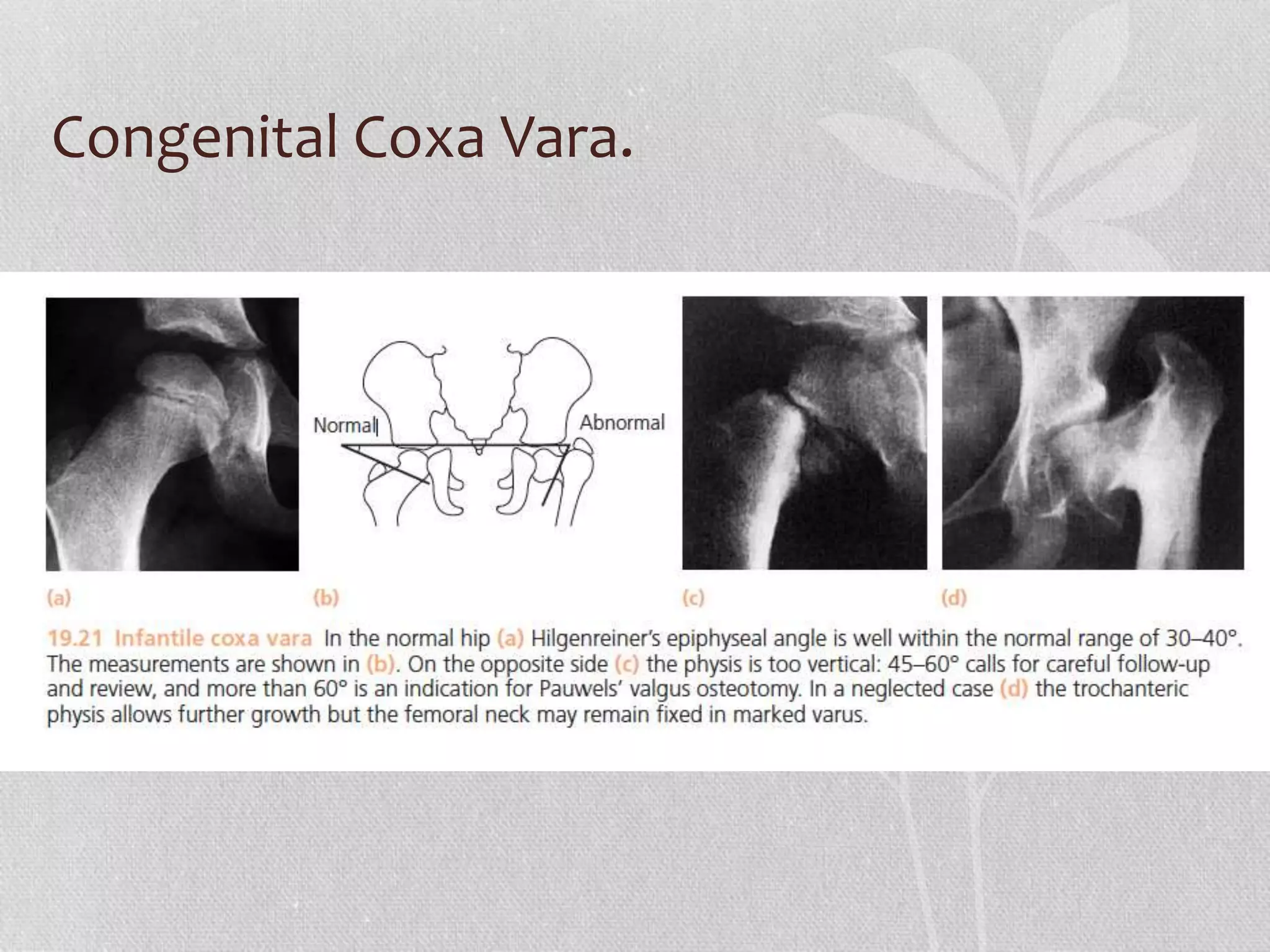Coxa Vara, Genu VArum & Valgum. Under Gradts. | PPTX