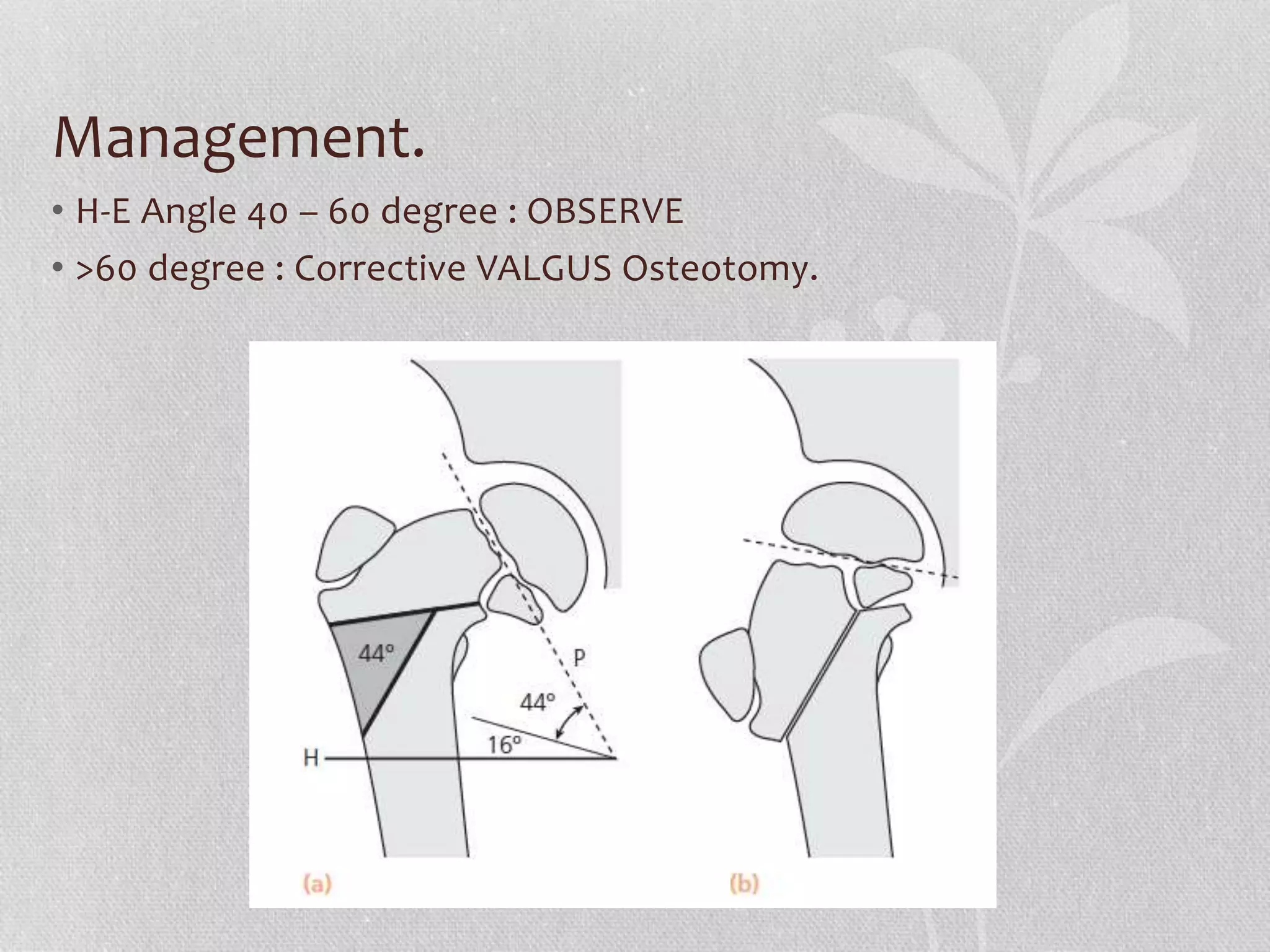 Coxa Vara, Genu VArum & Valgum. Under Gradts. | PPTX