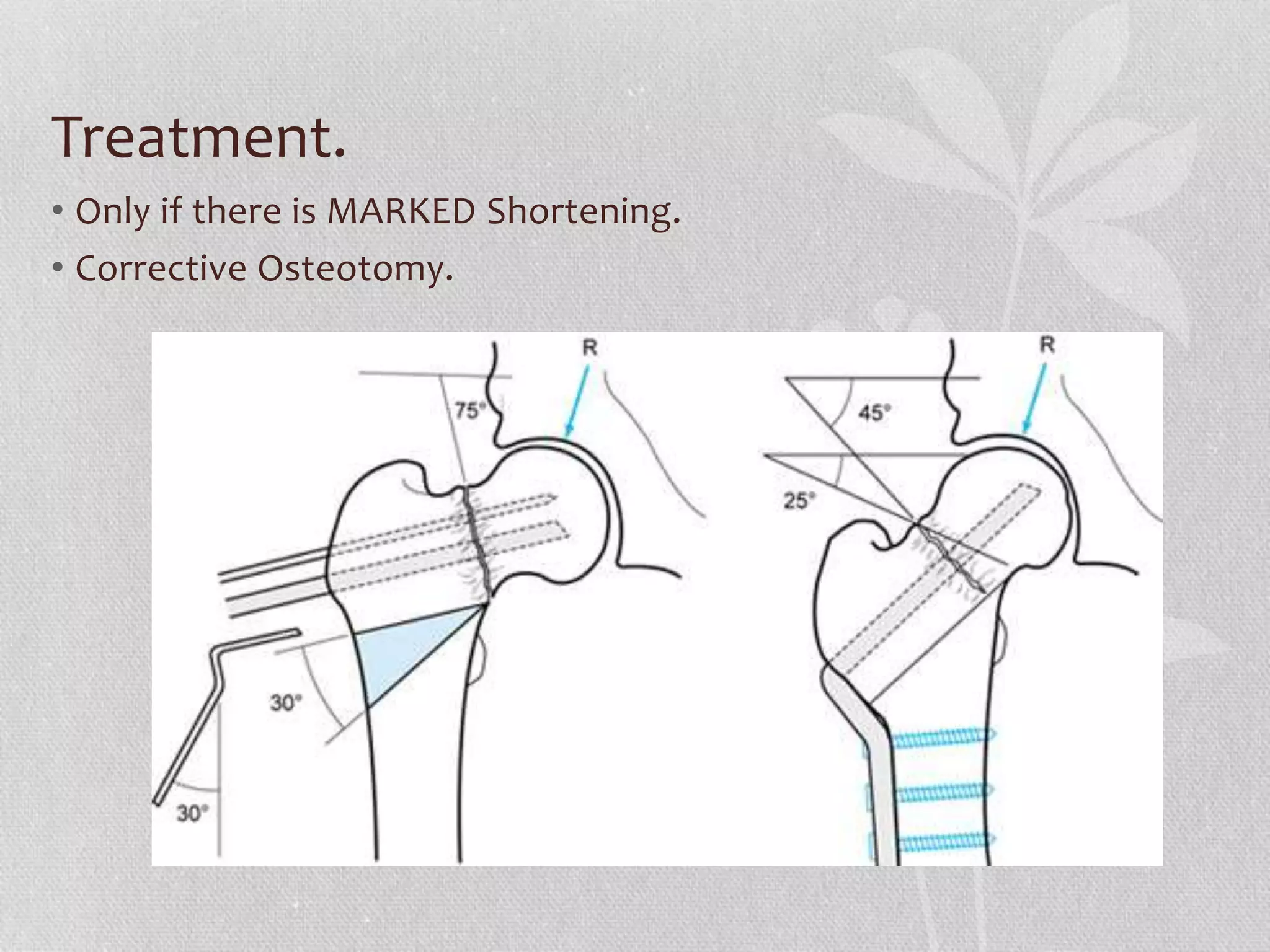 Coxa Vara, Genu VArum & Valgum. Under Gradts. | PPTX