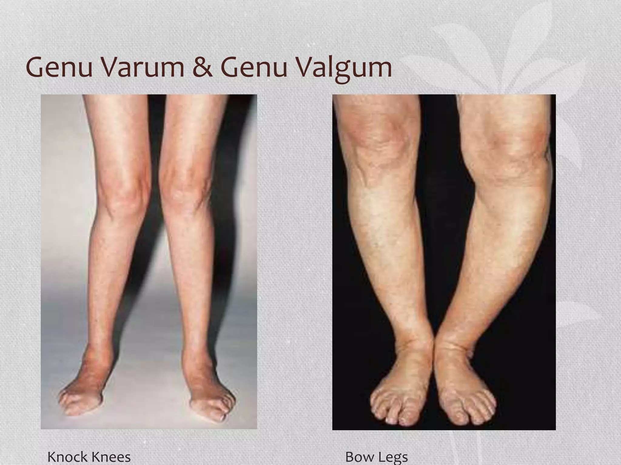 Coxa Vara, Genu VArum & Valgum. Under Gradts. | PPTX