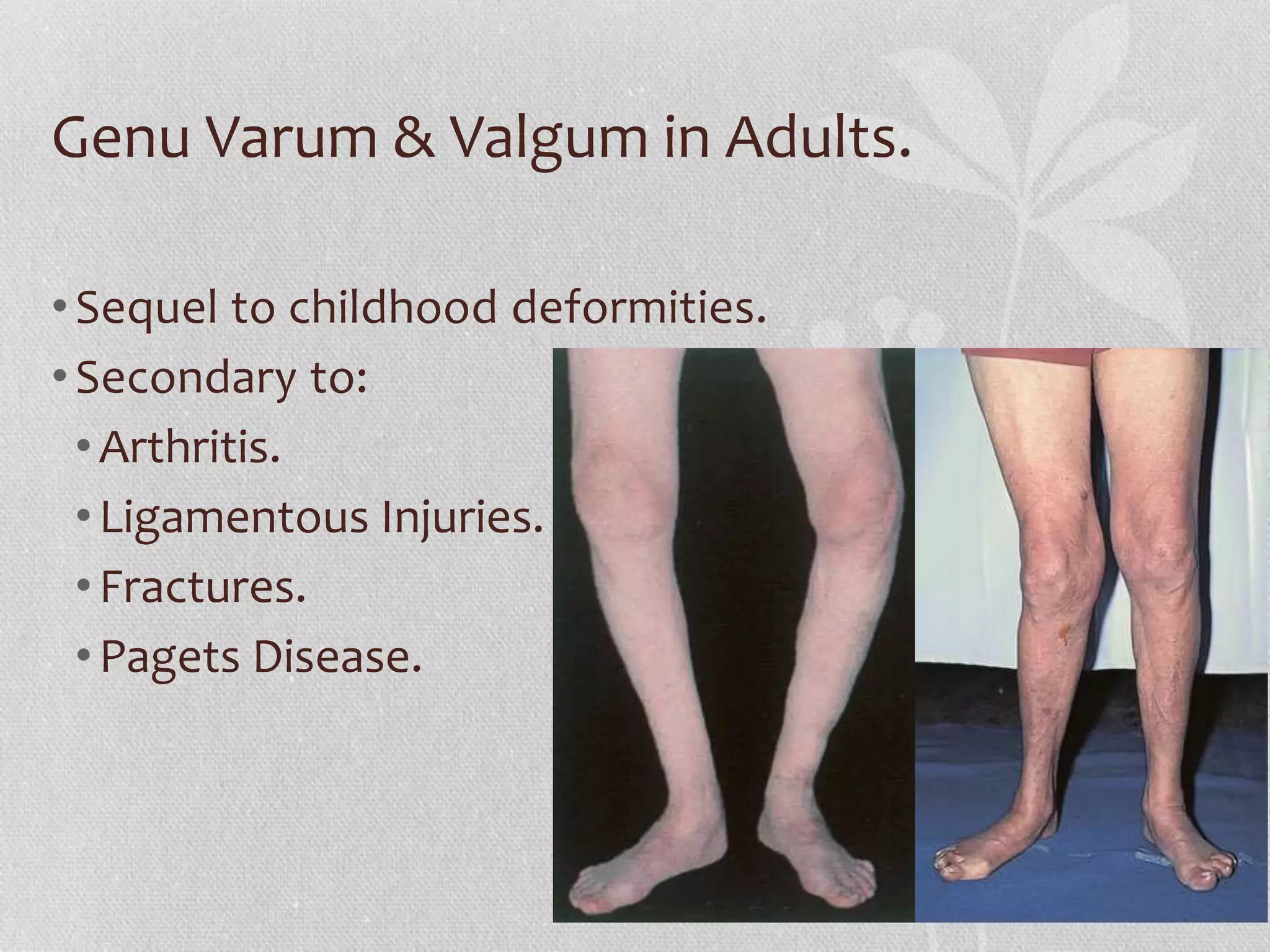 Coxa Vara, Genu VArum & Valgum. Under Gradts. | PPTX
