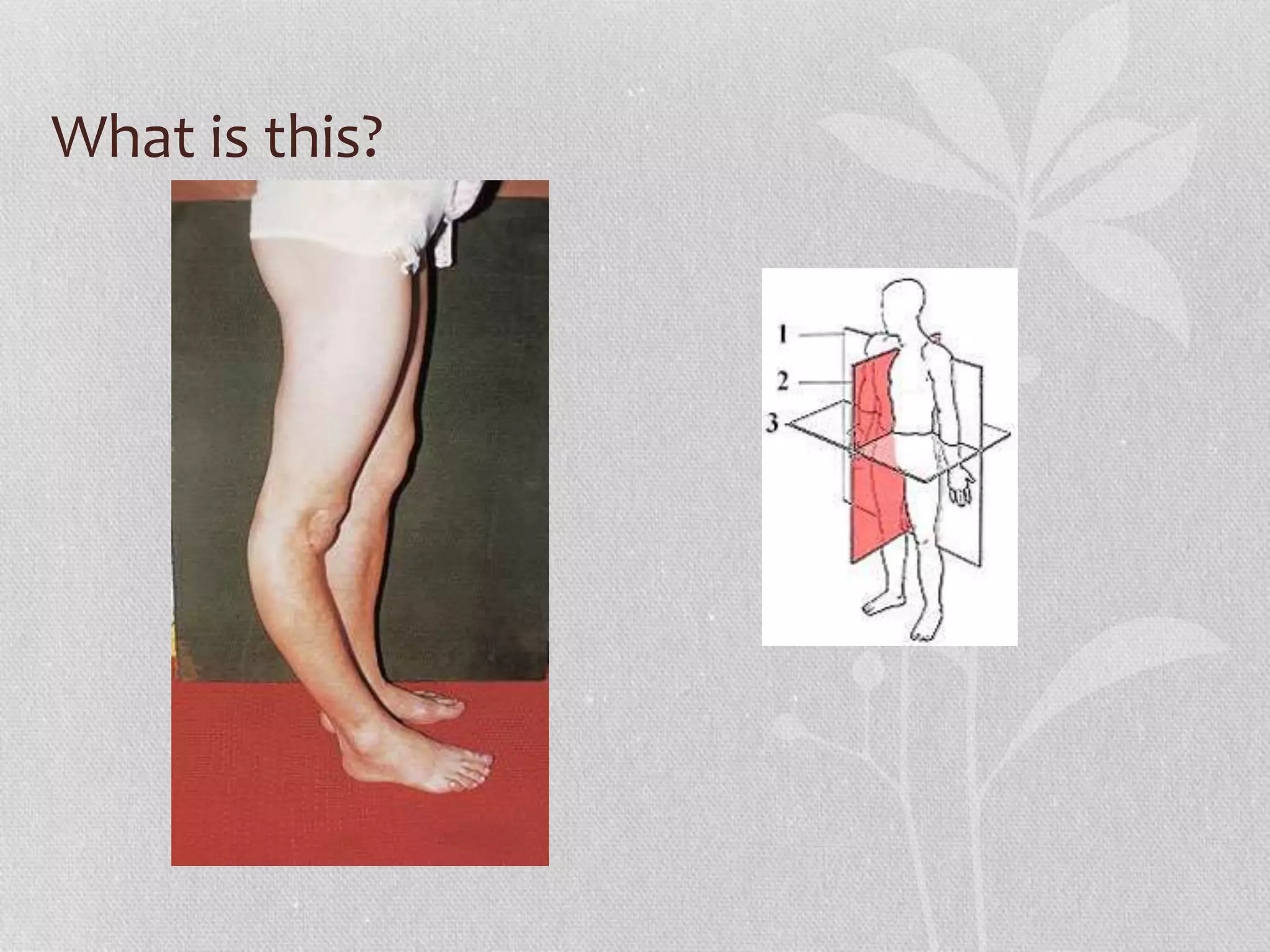 Coxa Vara, Genu VArum & Valgum. Under Gradts. | PPTX