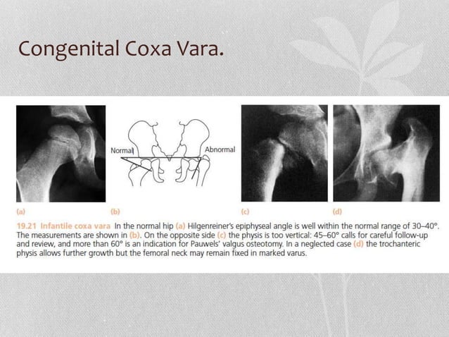 Coxa Vara, Genu VArum & Valgum. Under Gradts. | PPTX