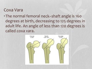 Coxa Valga Genu Varum