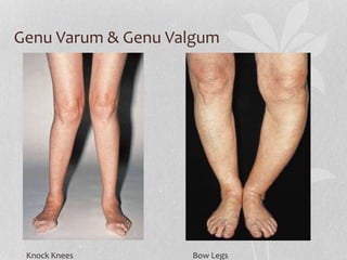 Coxa Valga Genu Varum