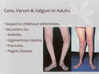 Coxa Valga Genu Varum