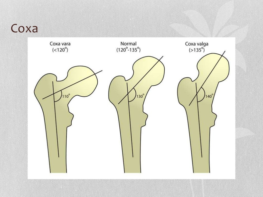 Coxa Vara, Genu VArum & Valgum. Under Gradts.