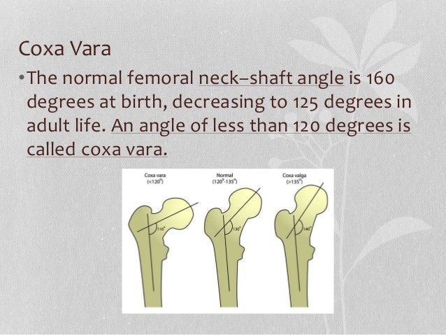 Coxa Vara, Genu VArum & Valgum. Under Gradts.