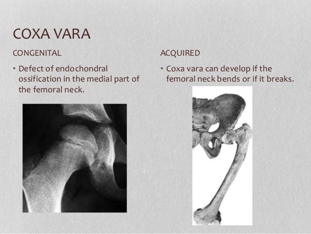 Coxa Vara, Genu VArum & Valgum. Under Gradts.