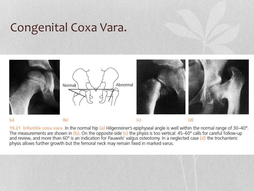 Coxa Vara, Genu VArum & Valgum. Under Gradts.