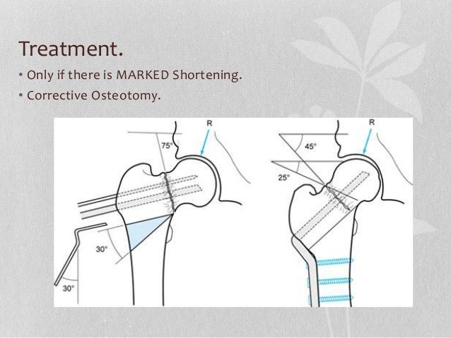 Coxa Vara, Genu VArum & Valgum. Under Gradts.