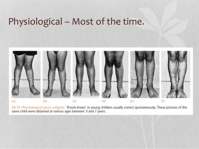 Coxa Vara, Genu VArum & Valgum. Under Gradts.