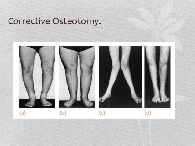Coxa Vara, Genu VArum & Valgum. Under Gradts.
