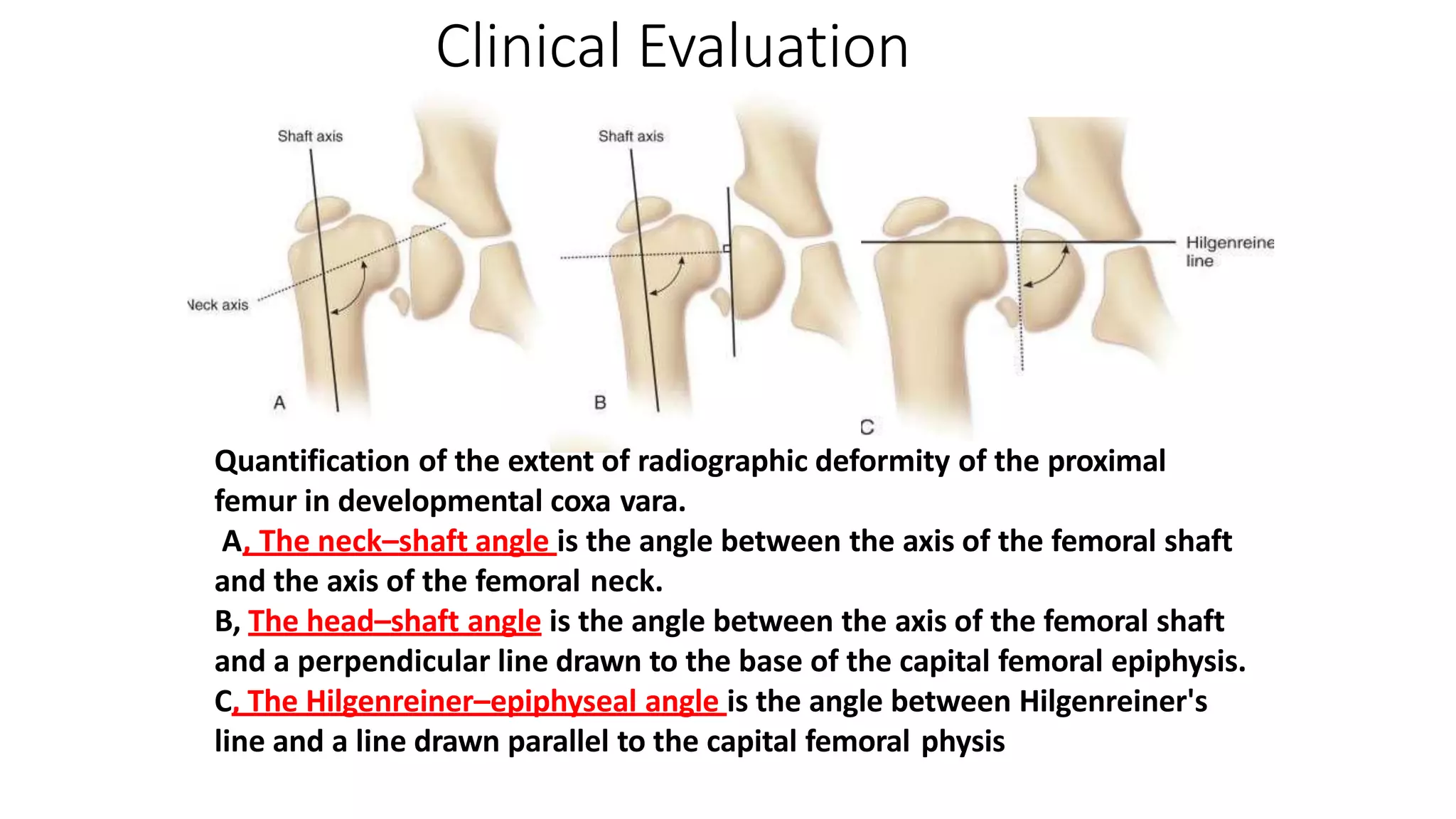 Coxa vara, chondrolysis of hip | PPTX