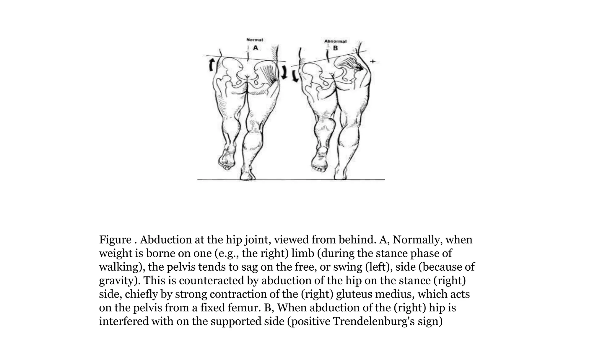 Coxa vara, chondrolysis of hip | PPTX