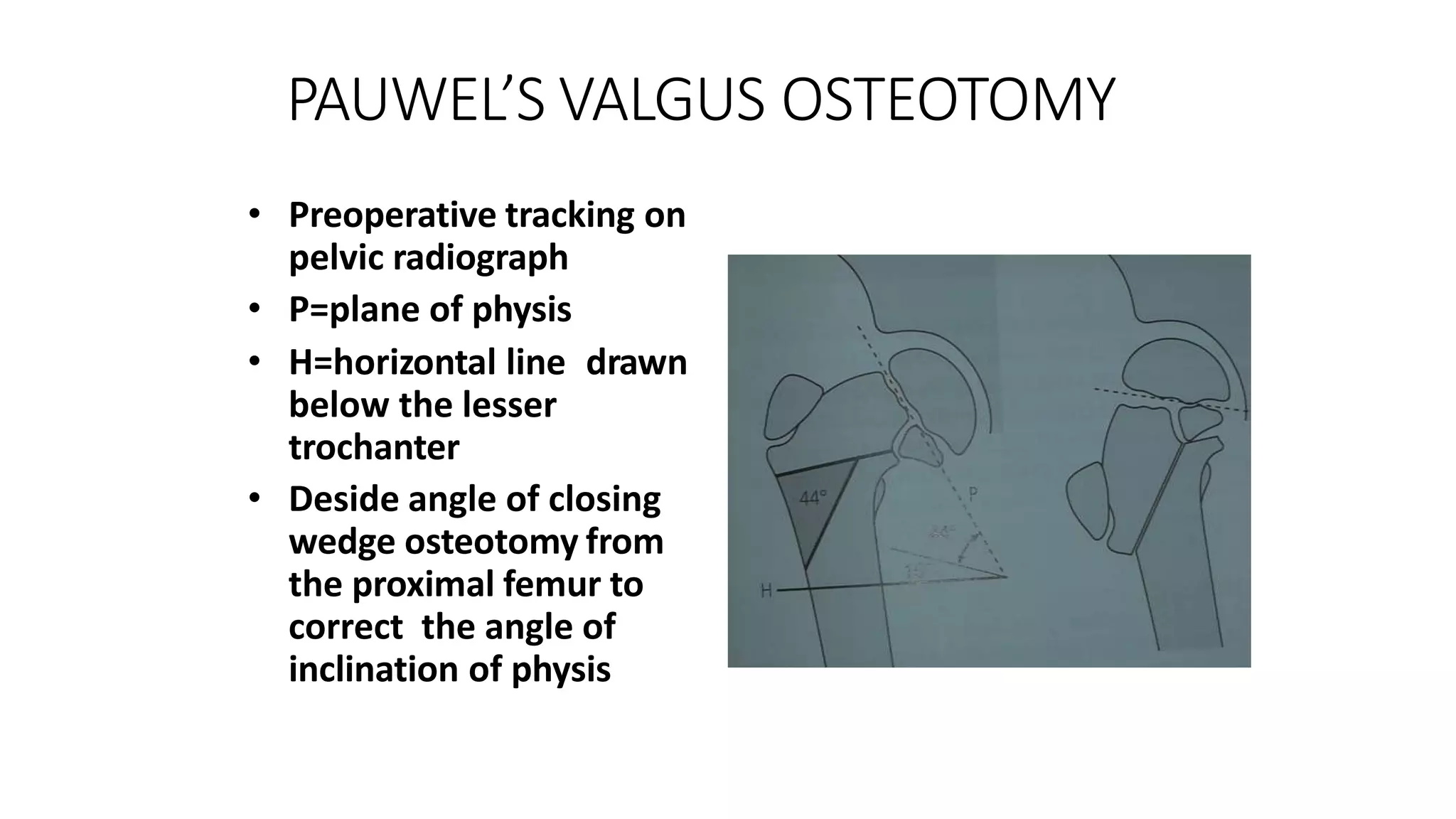 Coxa vara, chondrolysis of hip | PPTX