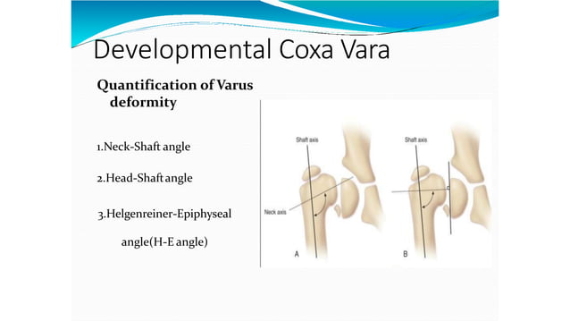 Coxa vara, chondrolysis of hip | PPTX