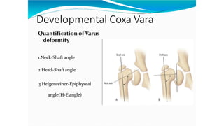 Coxa vara, chondrolysis of hip | PPT