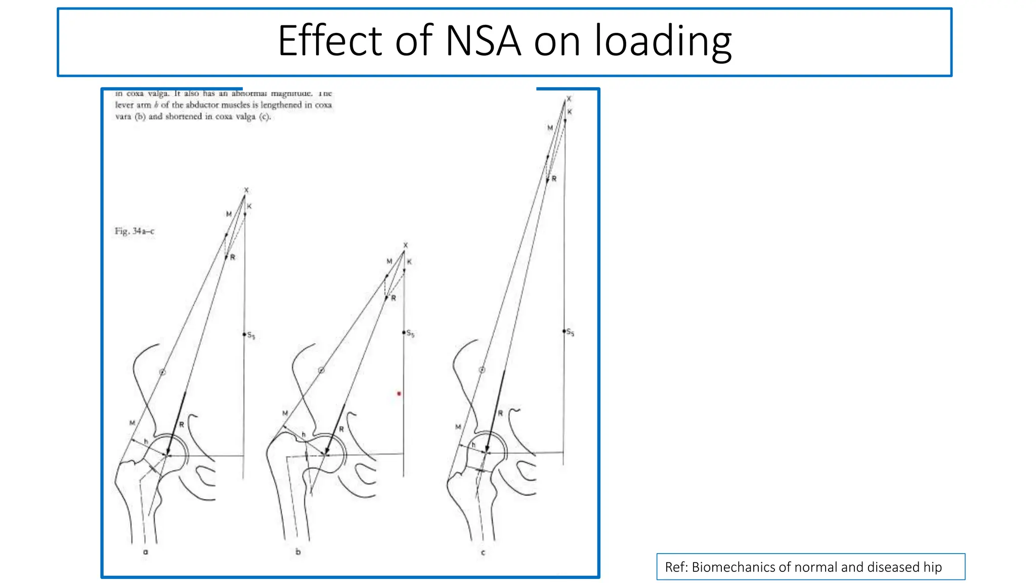 COXA VARA AND COXA VALGA, DEVLOPMENTAL COXA VARA.pptx