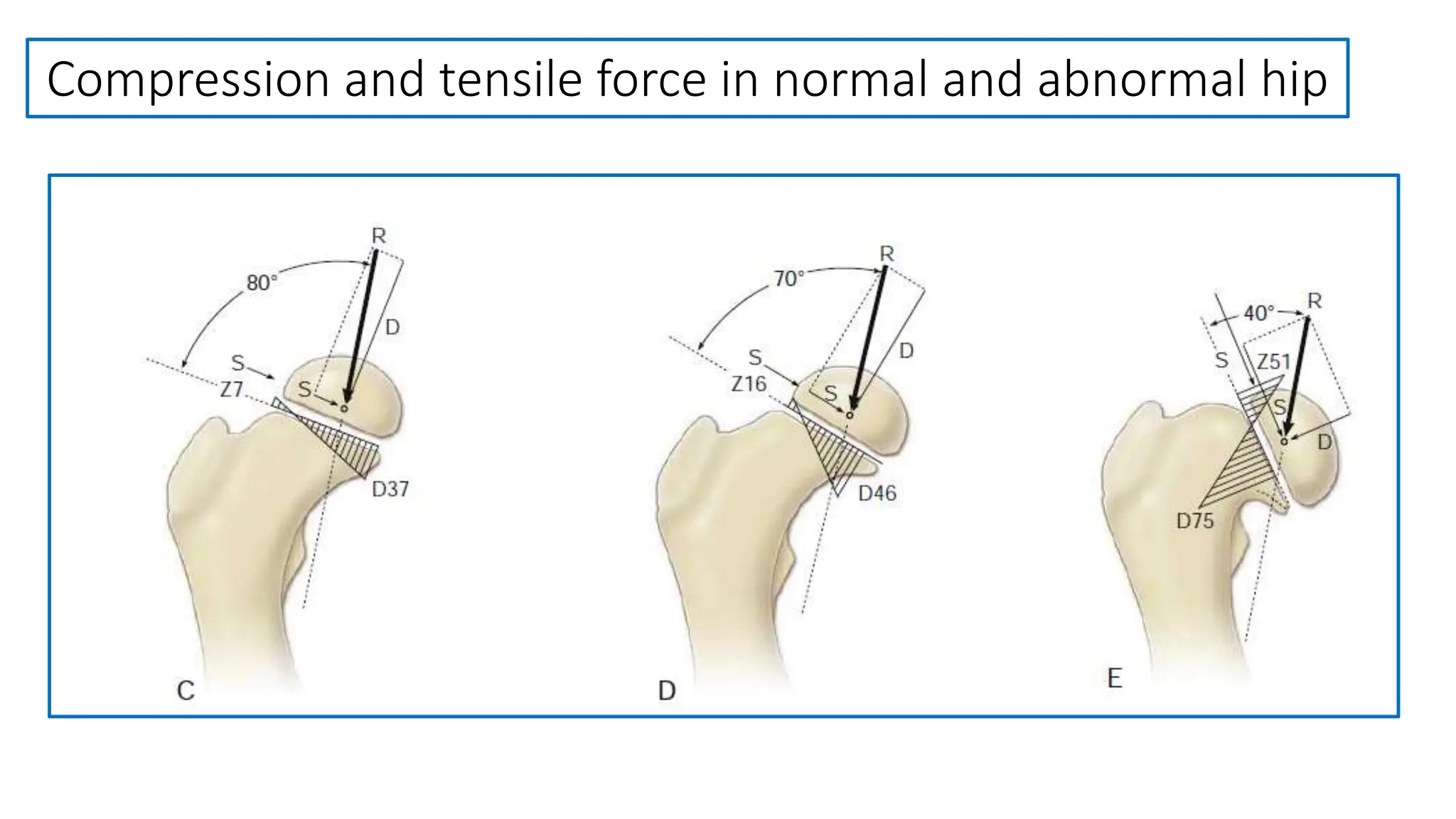 COXA VARA AND COXA VALGA, DEVLOPMENTAL COXA VARA.pptx