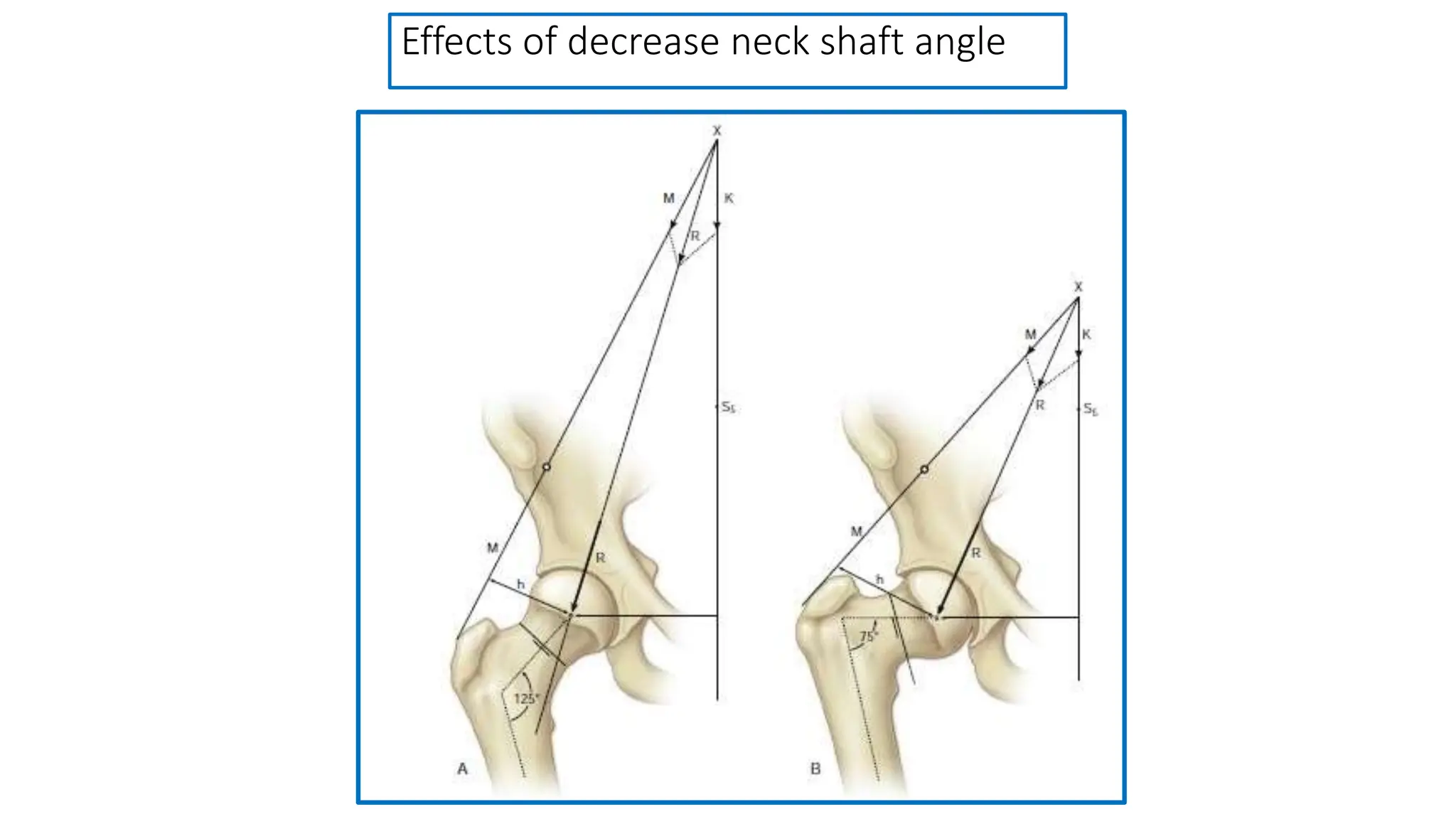 COXA VARA AND COXA VALGA, DEVLOPMENTAL COXA VARA.pptx